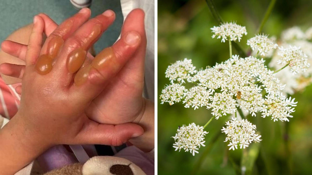 Giant hogweed warning Bolton: Schoolgirl suffers horrific burns in ...