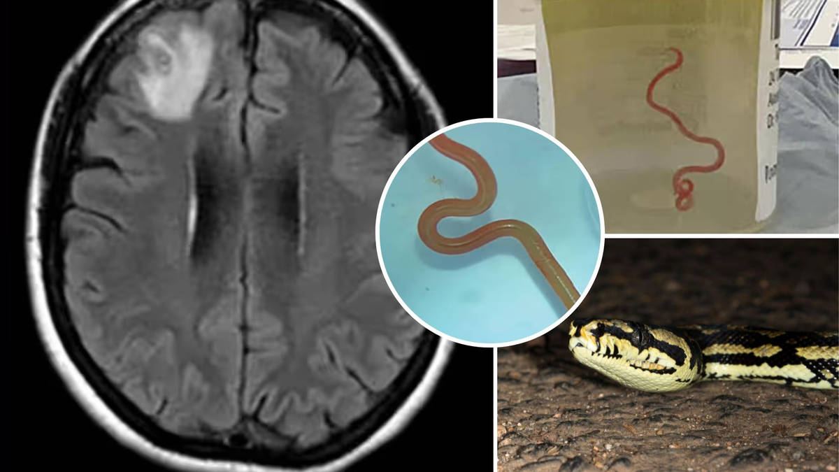 Parasitic 8cm-long worm found ‘alive and wriggling’ in woman’s brain ...