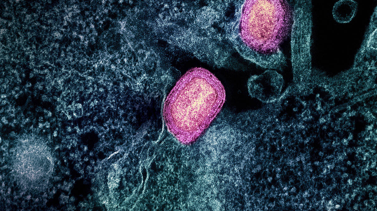 New mpox case discovered in Leeds after patient returned to UK from ...