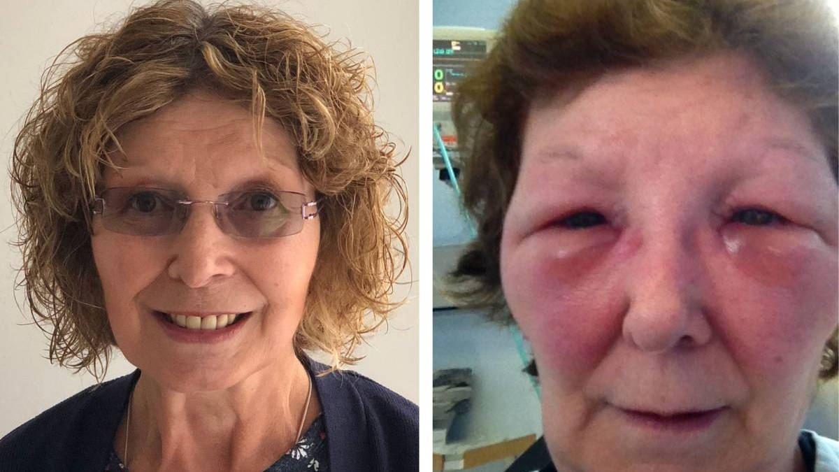 'My face was swelling up like Frankenstein's Monster': LBC uncovers ...